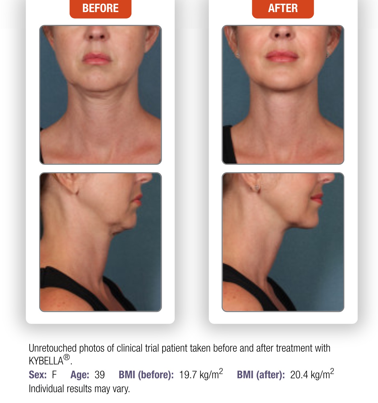 Kybella-Best Non Invasive Treatment : Culver City, Las Vegas