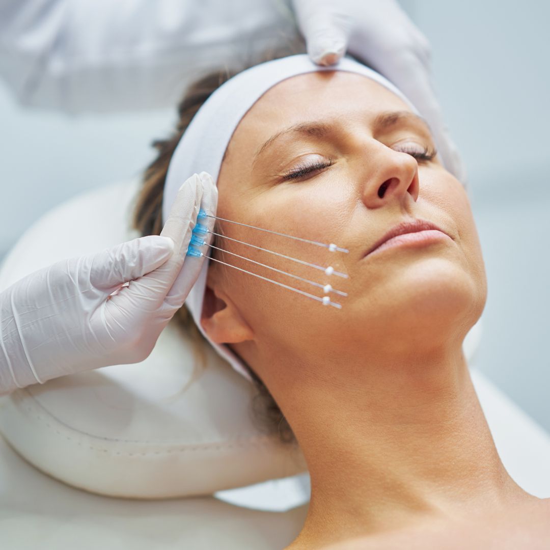 The Science Behind Thread Lifting | Cosmetique Aesthetics